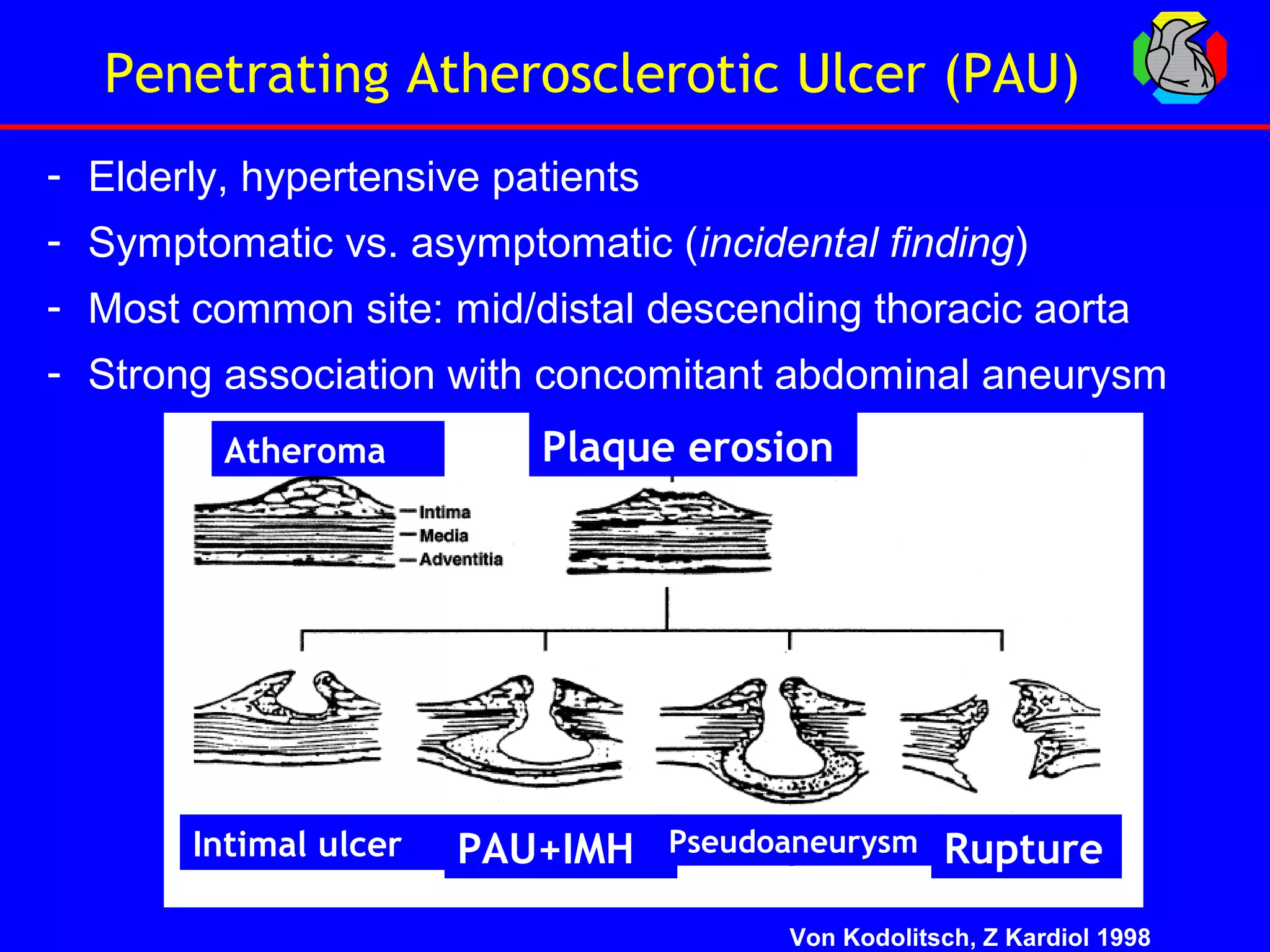 Aortic ulcer intramural hematoma aortic dissection | PPT