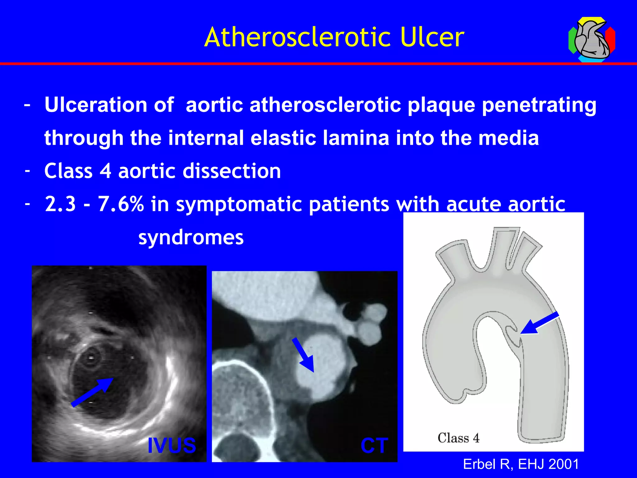 Aortic ulcer intramural hematoma aortic dissection | PPT