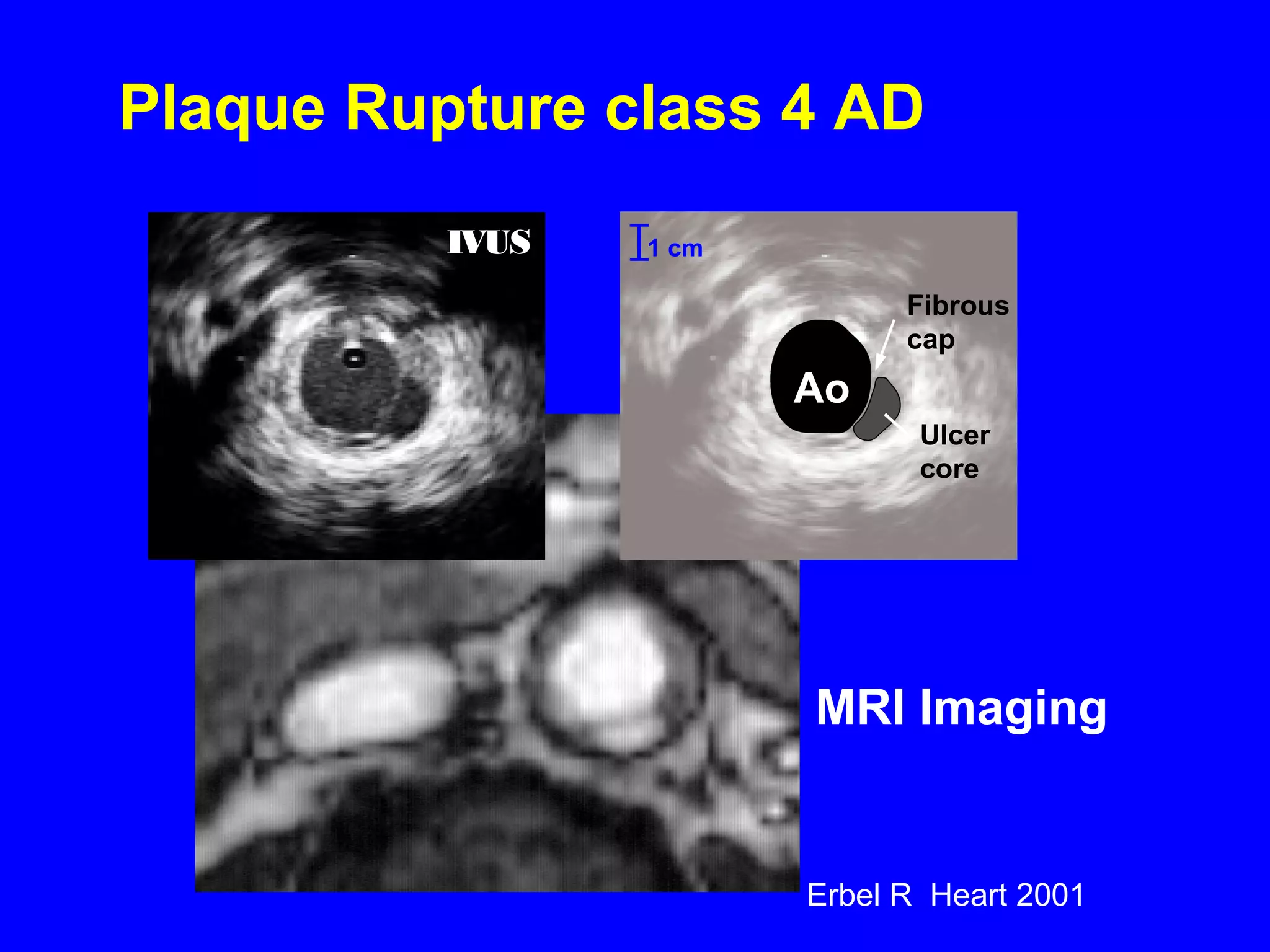 Aortic ulcer intramural hematoma aortic dissection | PPT