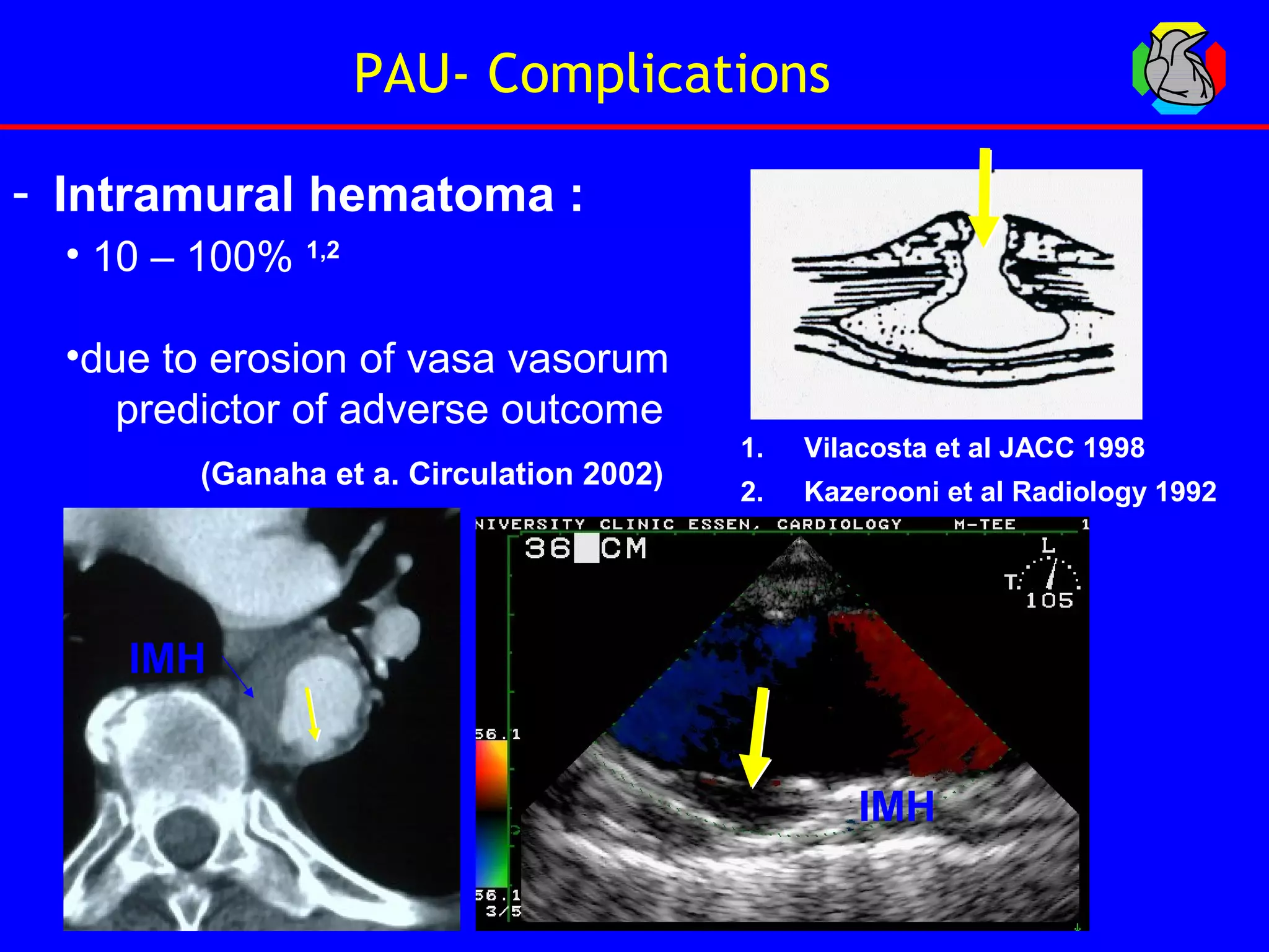 Aortic ulcer intramural hematoma aortic dissection | PPT