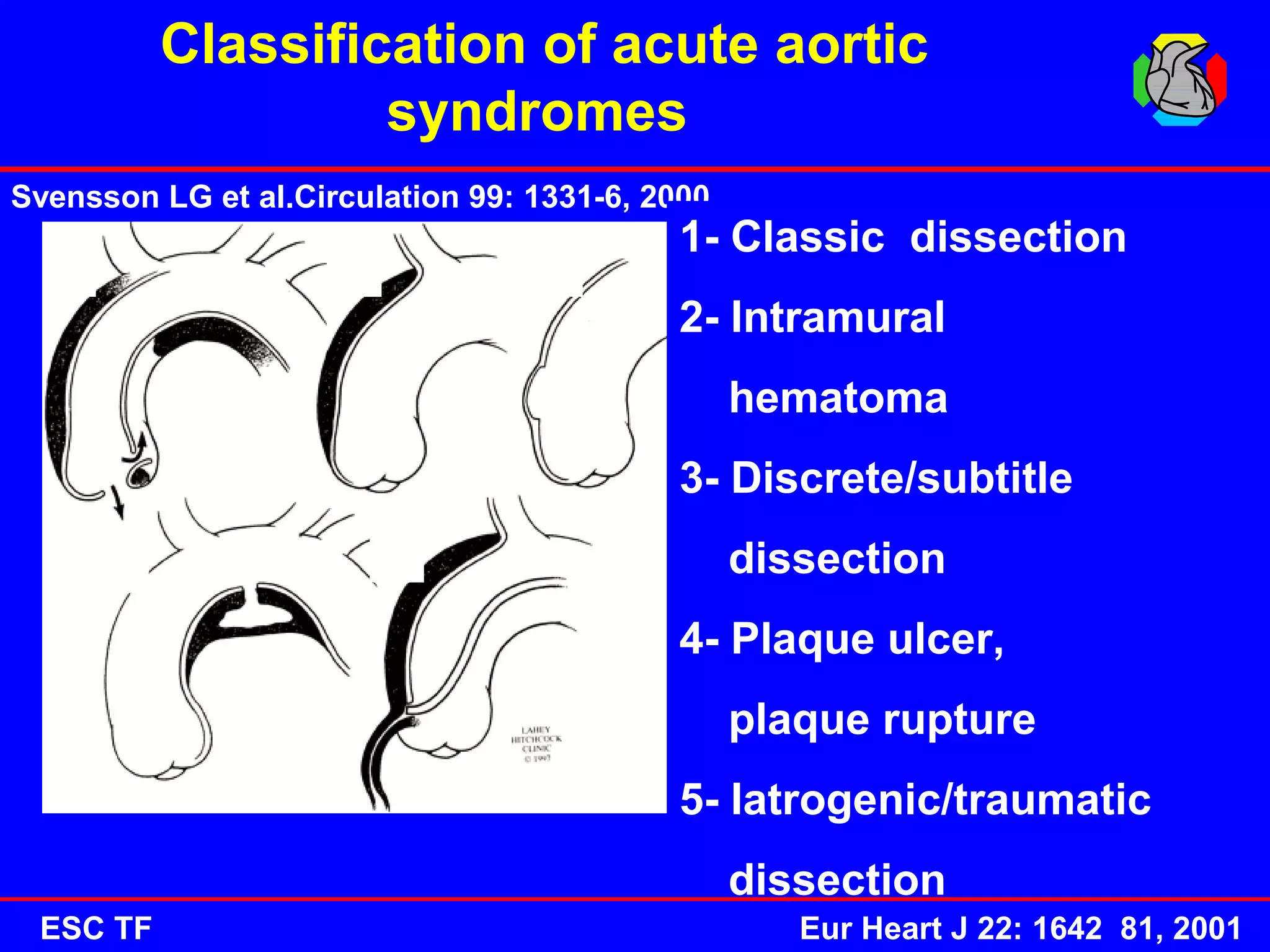 Aortic ulcer intramural hematoma aortic dissection | PPT