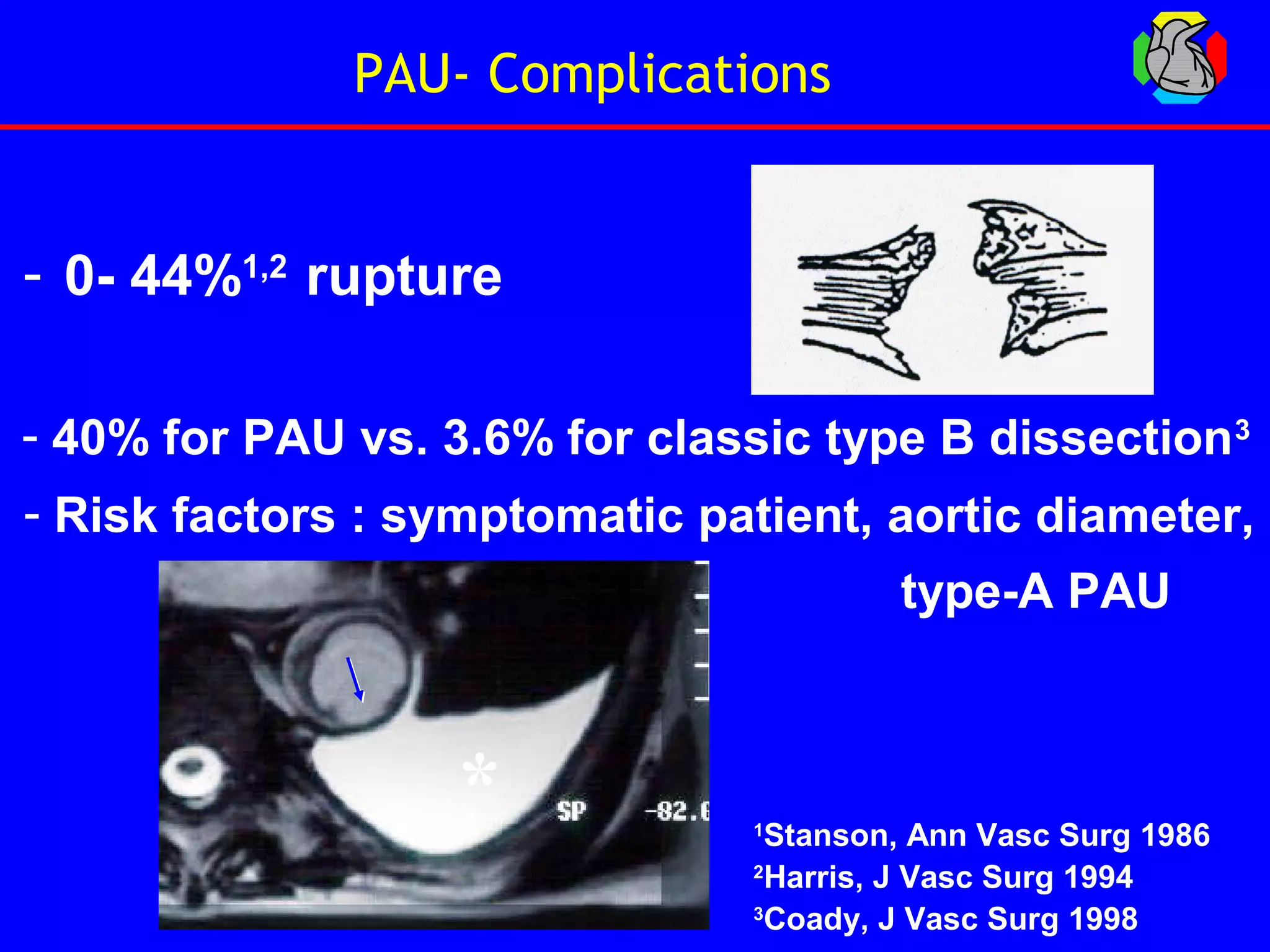Aortic ulcer intramural hematoma aortic dissection | PPT