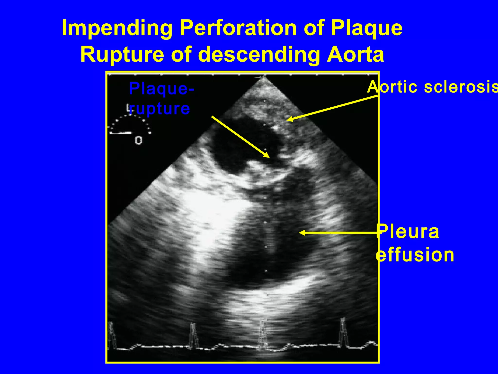 Aortic ulcer intramural hematoma aortic dissection | PPT