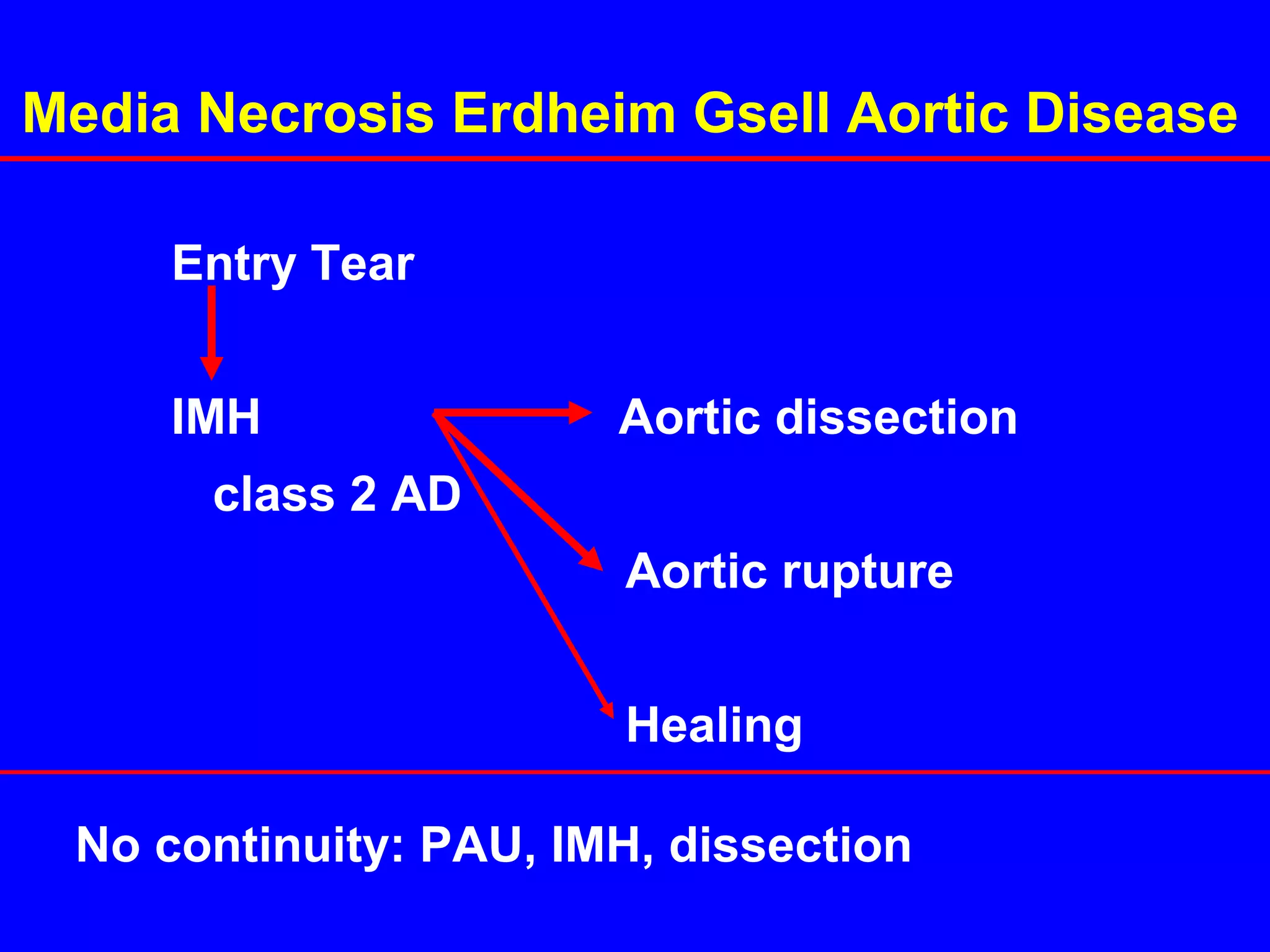 Aortic ulcer intramural hematoma aortic dissection | PPT