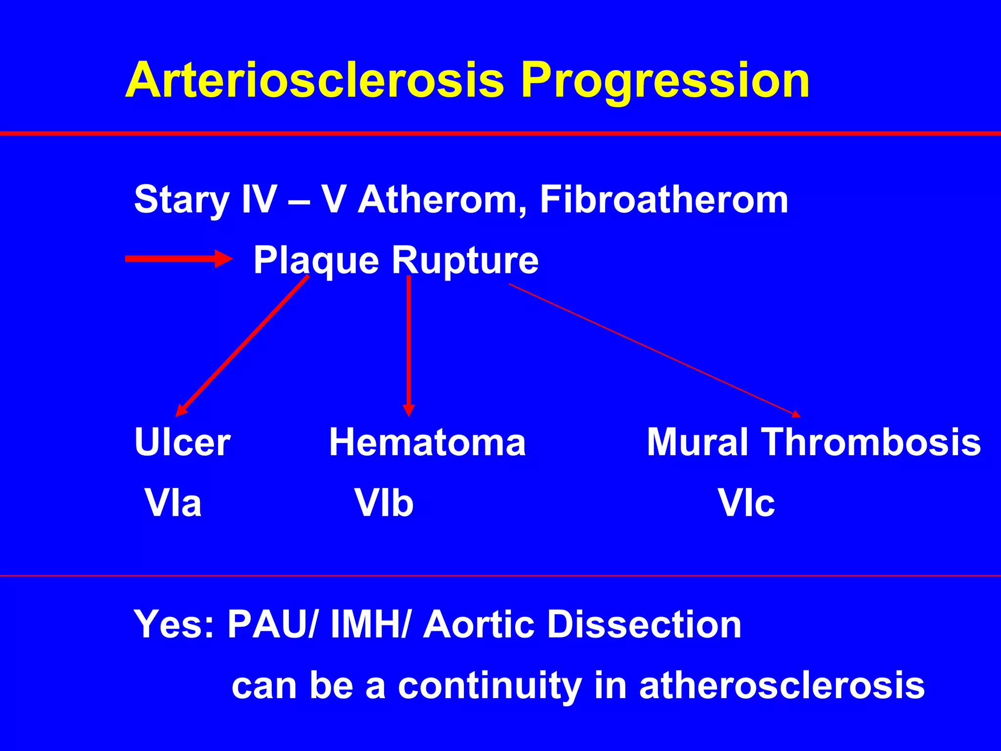Aortic ulcer intramural hematoma aortic dissection | PPT
