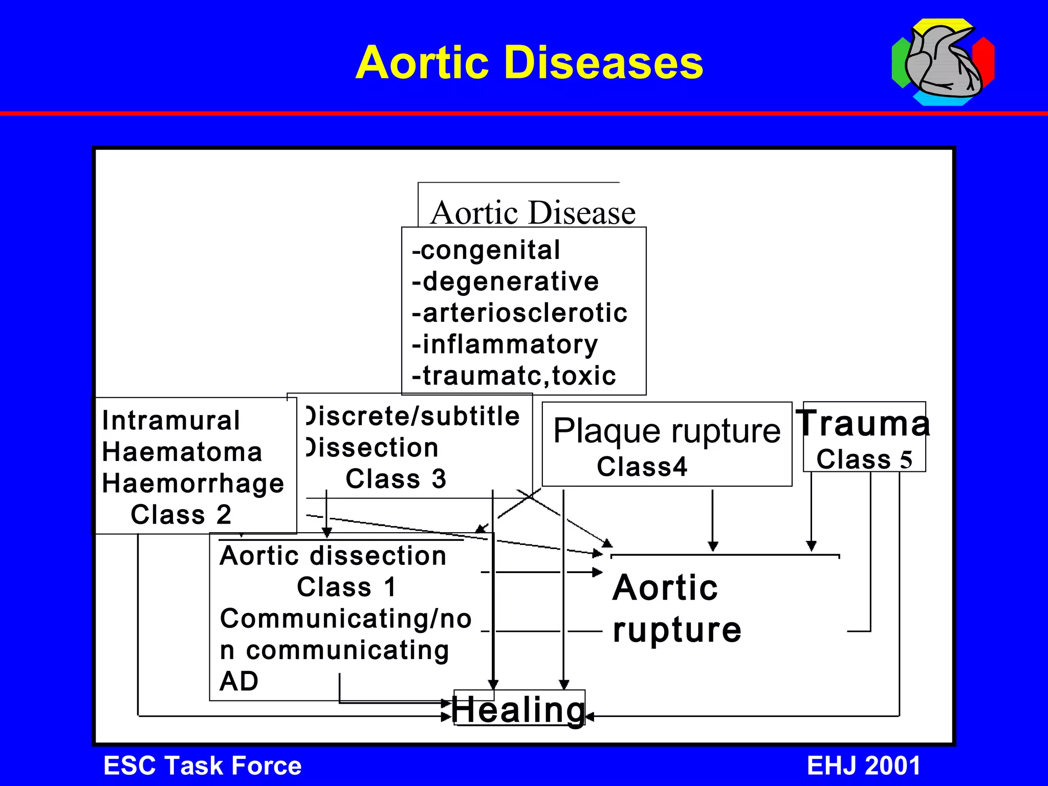 Aortic ulcer intramural hematoma aortic dissection | PPT