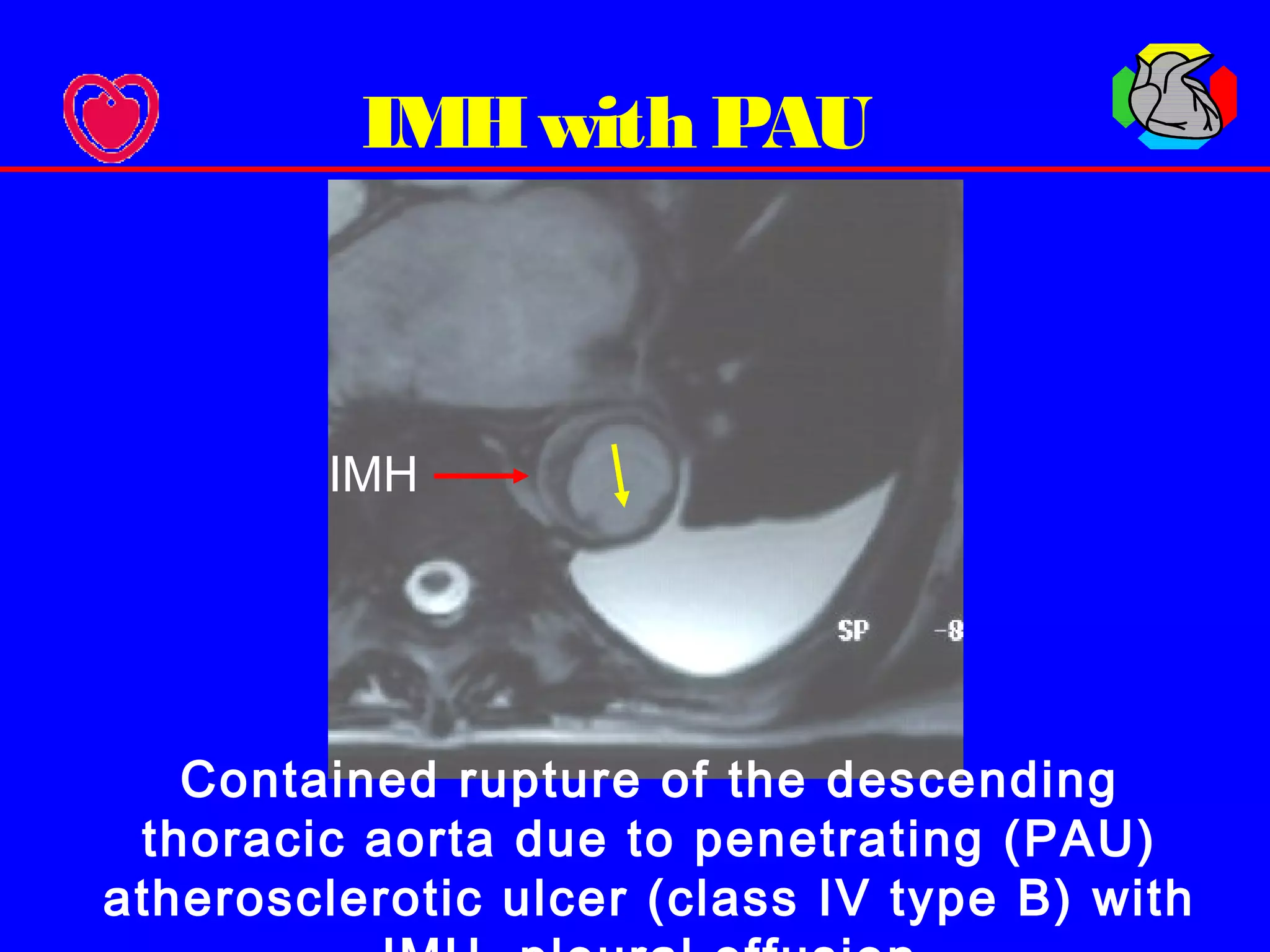 Aortic ulcer intramural hematoma aortic dissection | PPT