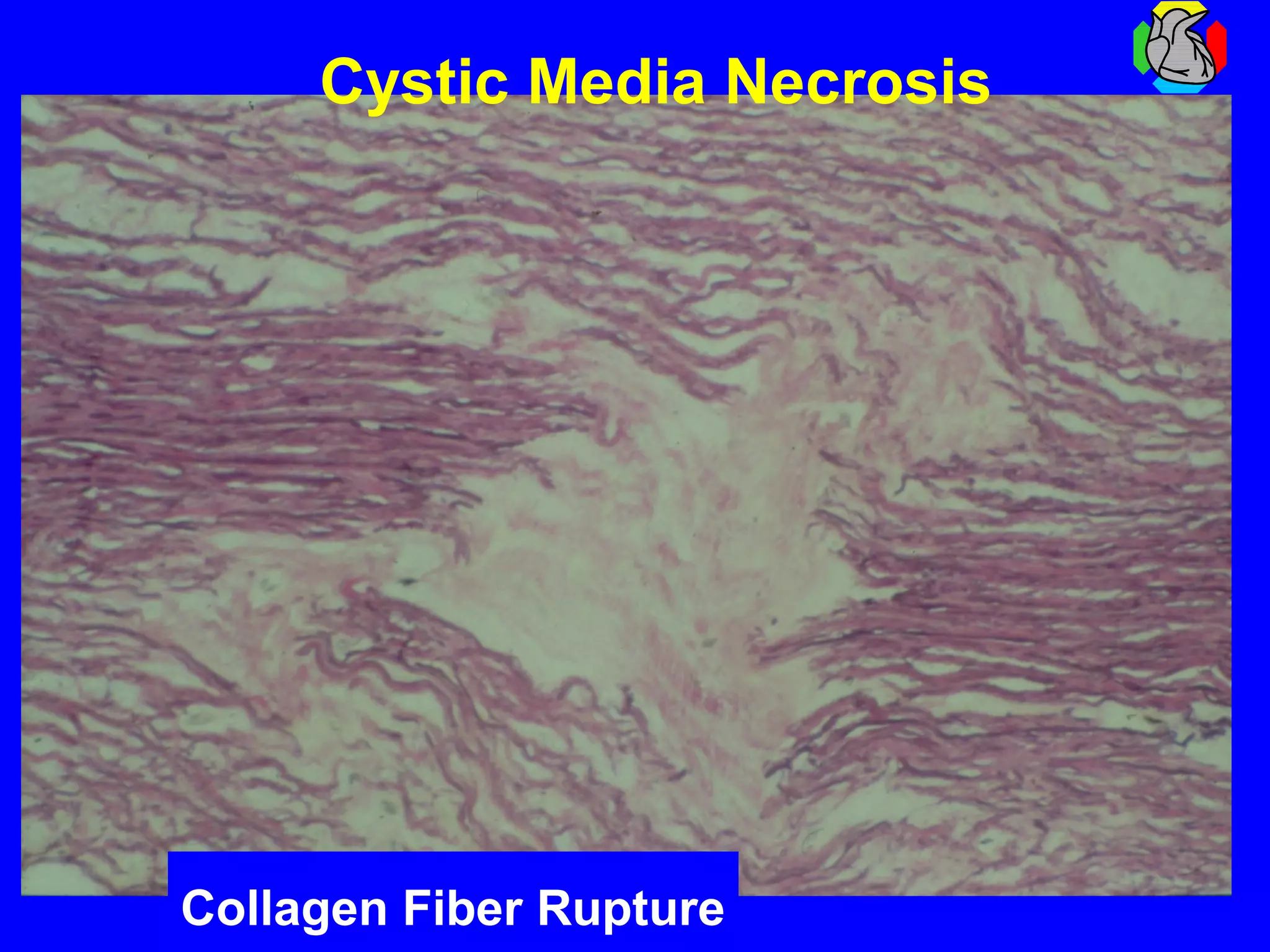 Aortic ulcer intramural hematoma aortic dissection | PPT