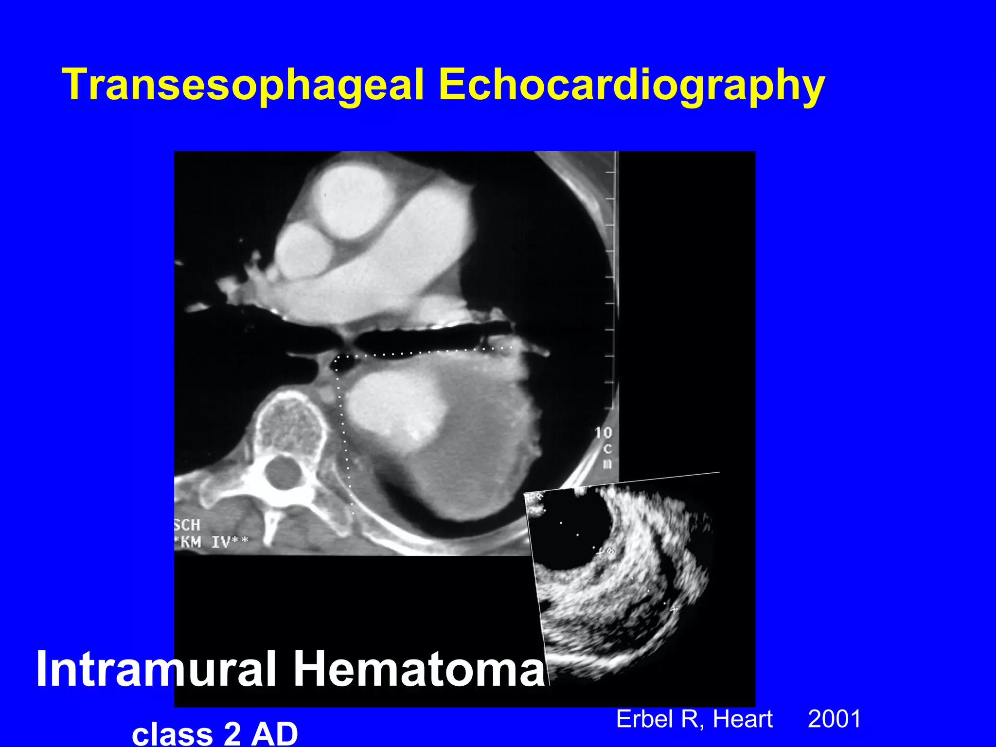 Aortic ulcer intramural hematoma aortic dissection | PPT