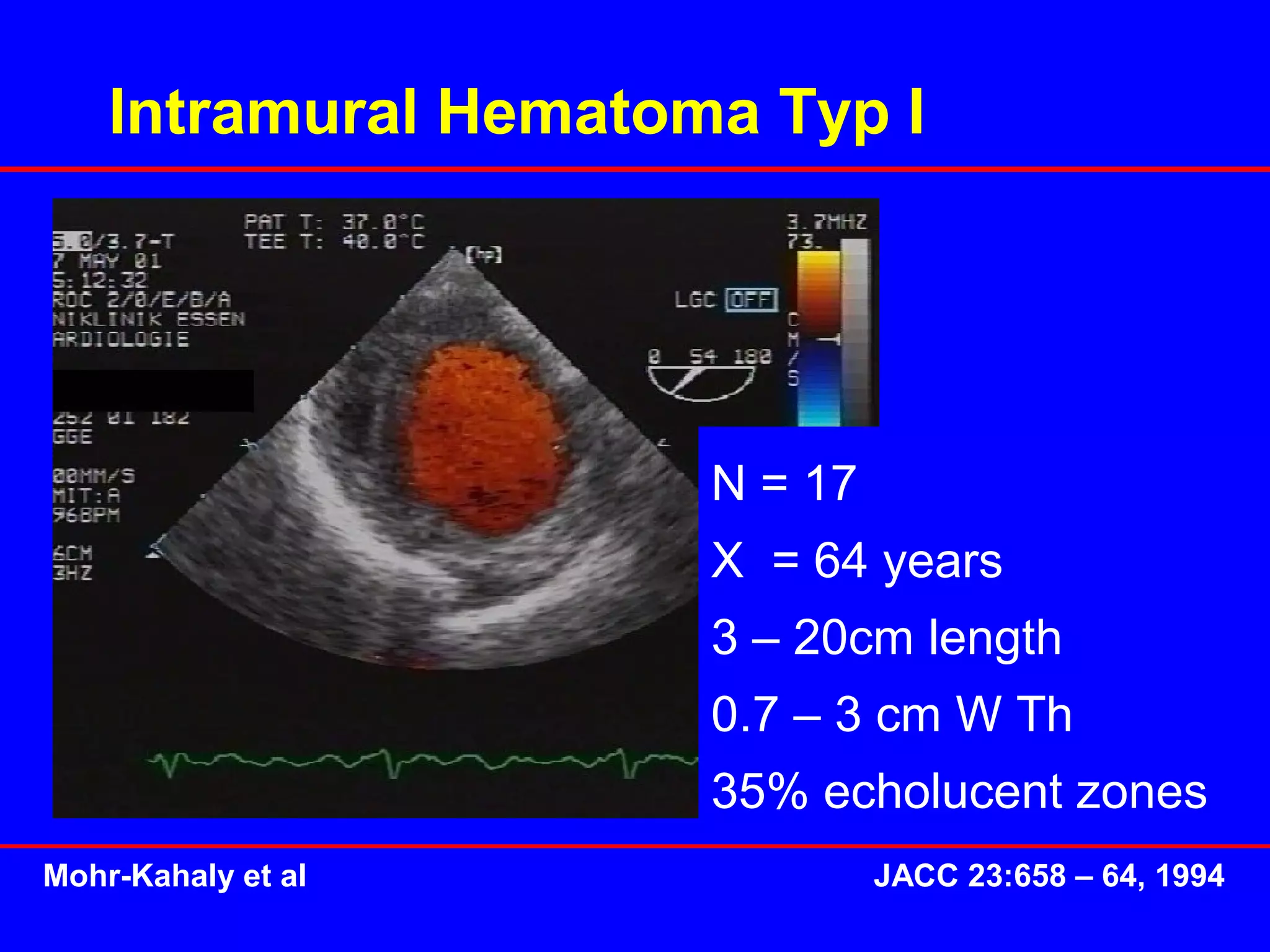 Aortic ulcer intramural hematoma aortic dissection | PPT