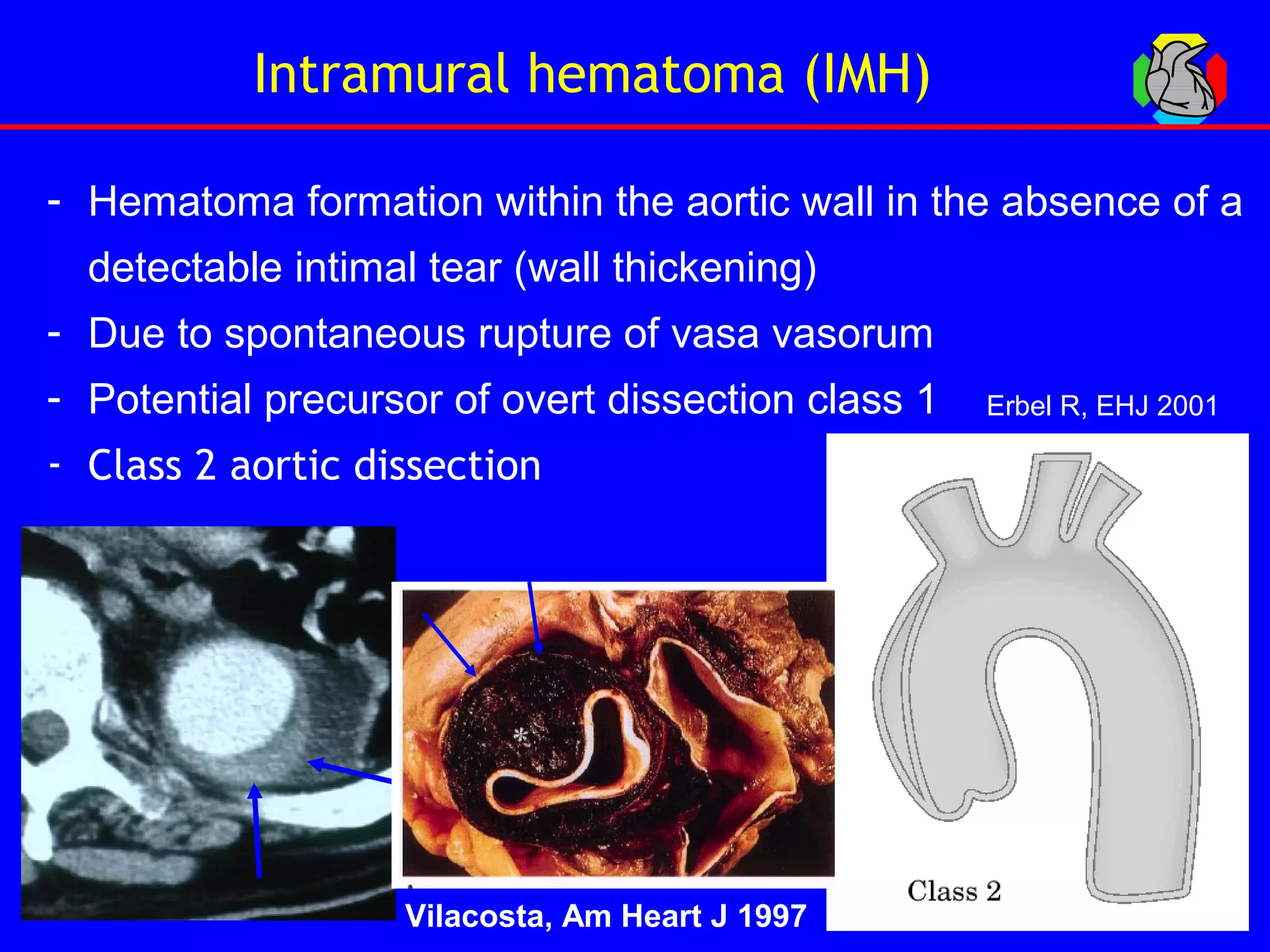 Aortic ulcer intramural hematoma aortic dissection | PPT
