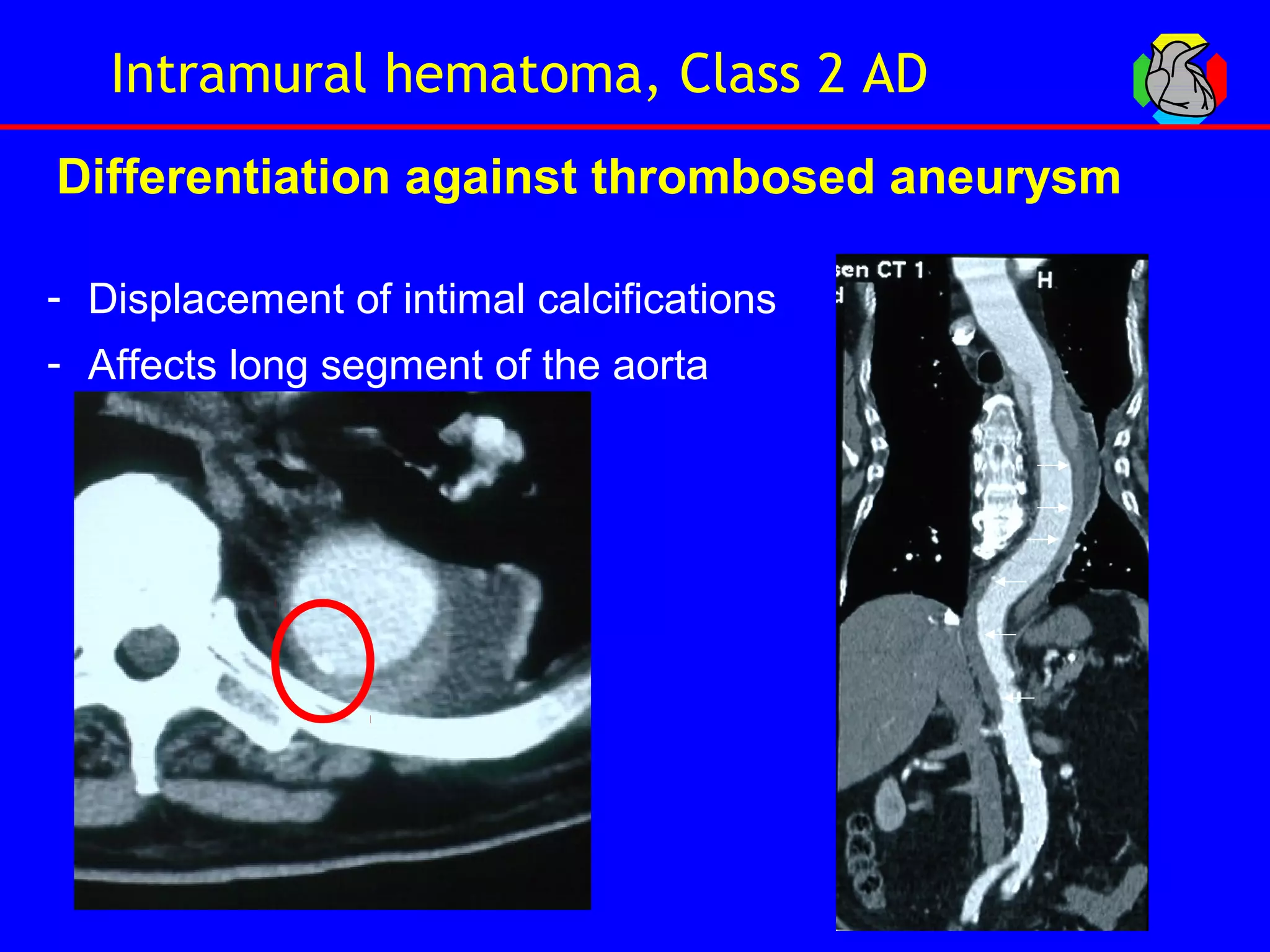 Aortic ulcer intramural hematoma aortic dissection | PPT