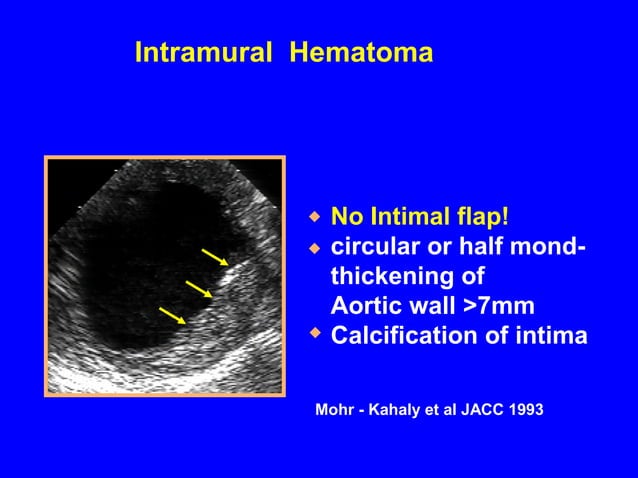 Aortic ulcer intramural hematoma aortic dissection | PPT