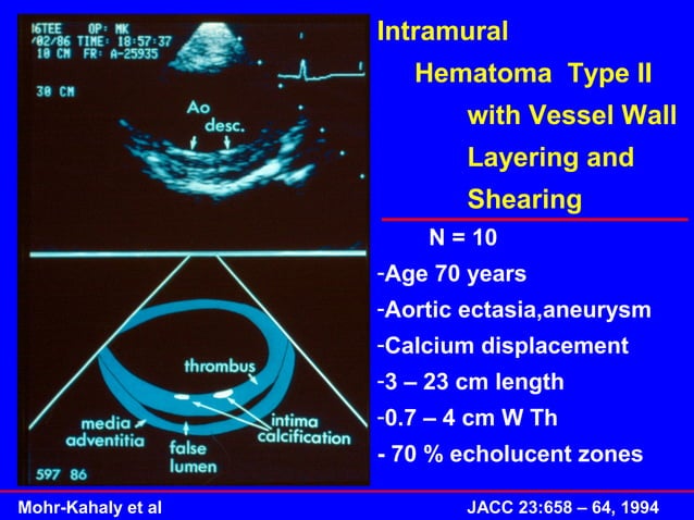 Aortic ulcer intramural hematoma aortic dissection | PPT