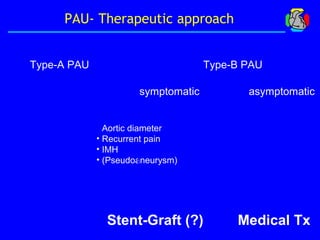 Aortic ulcer intramural hematoma aortic dissection | PPT