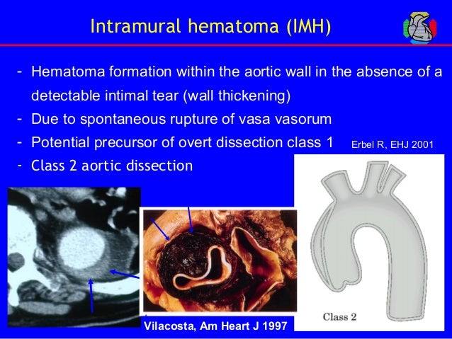 Aortic ulcer intramural hematoma aortic dissection