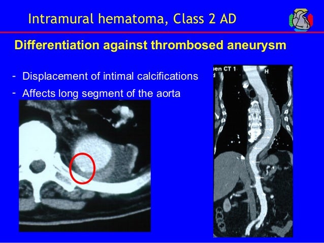 Aortic ulcer intramural hematoma aortic dissection
