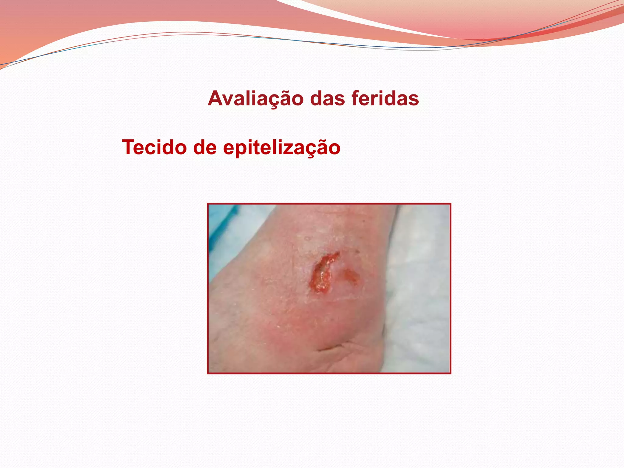 Avaliacao das feridas | PPT