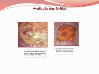 Avaliacao das feridas | PPT