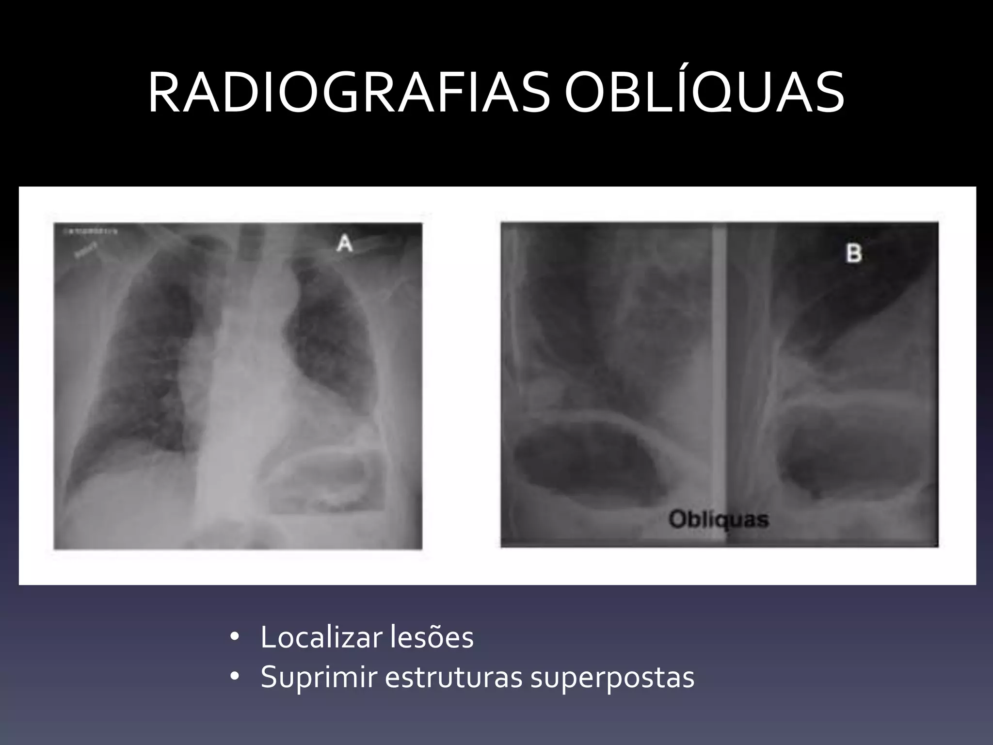Avaliação sistemática da radiografia do tórax | PPT