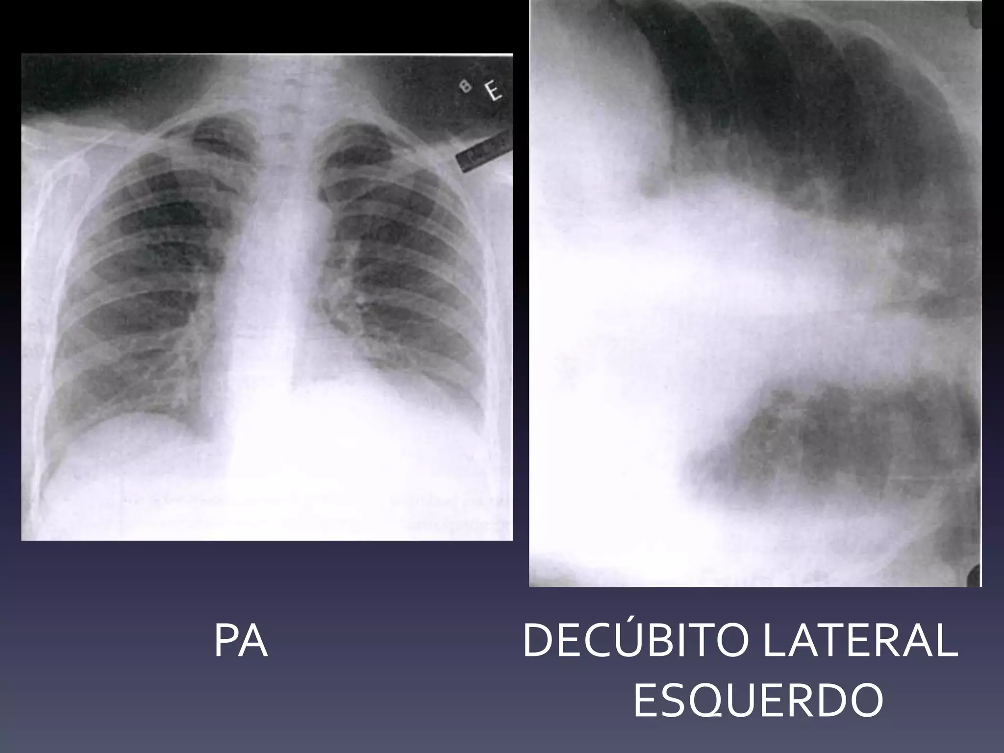 Avaliação sistemática da radiografia do tórax | PPT