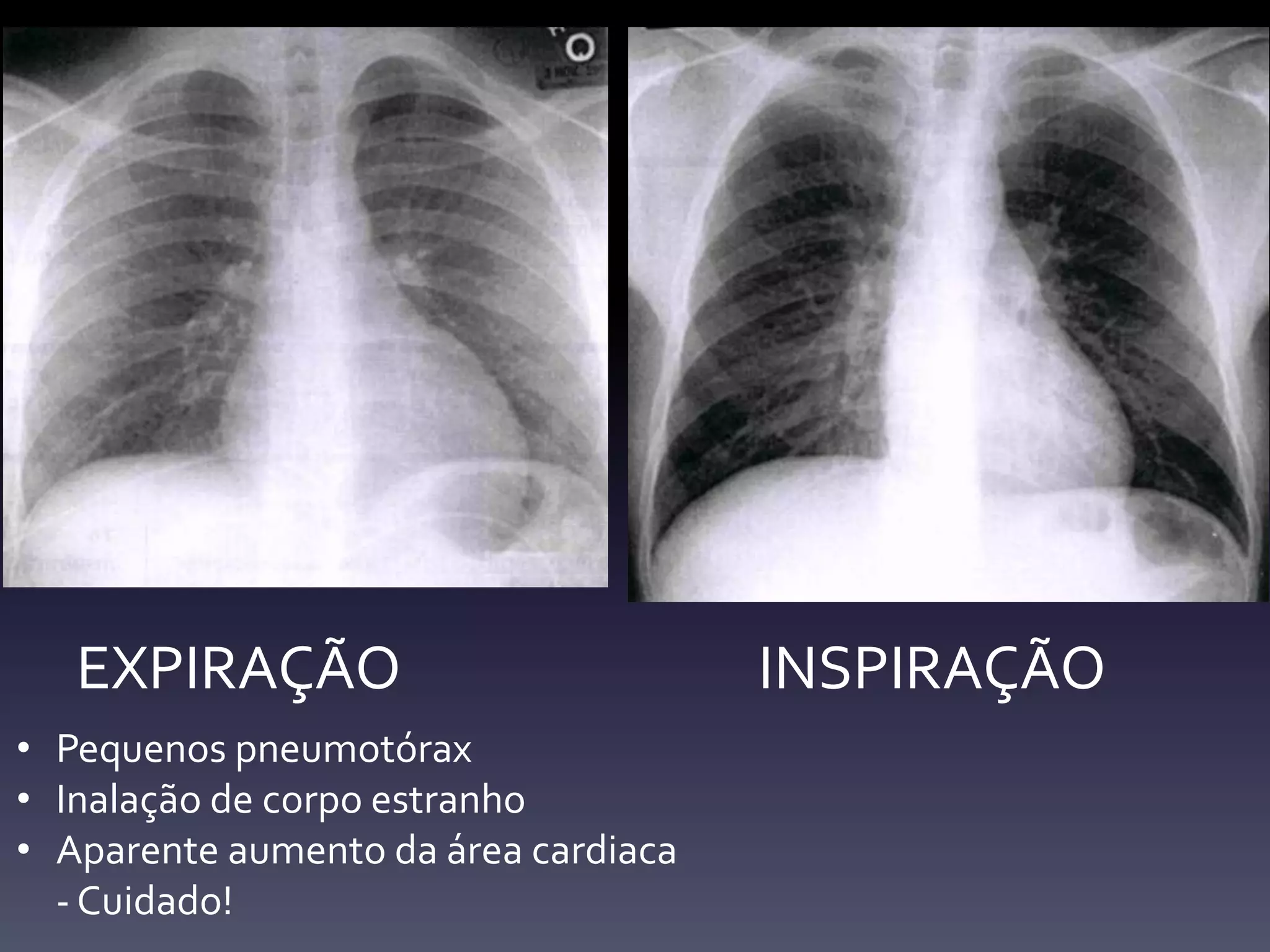 Avaliação sistemática da radiografia do tórax | PPT