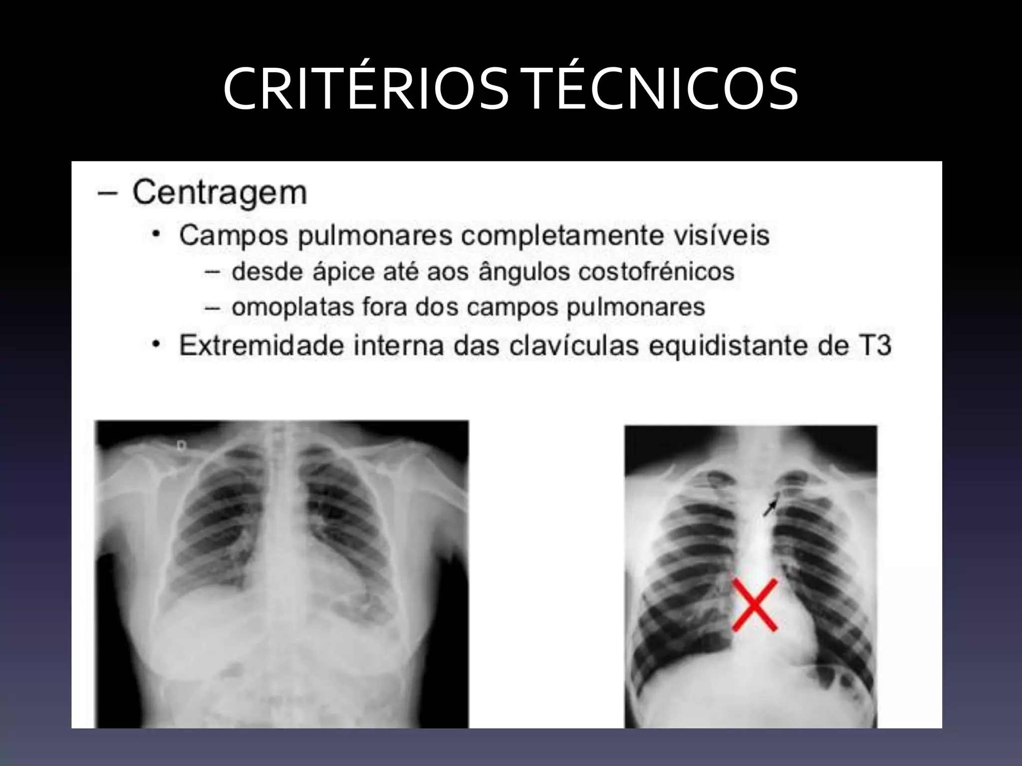 Avaliação sistemática da radiografia do tórax | PPT