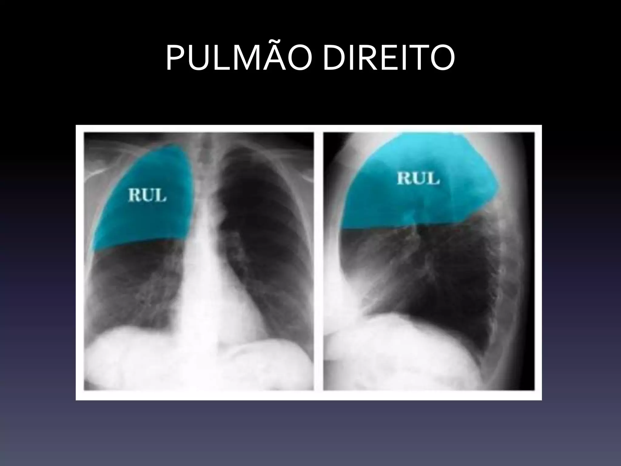 Avaliação sistemática da radiografia do tórax | PPT