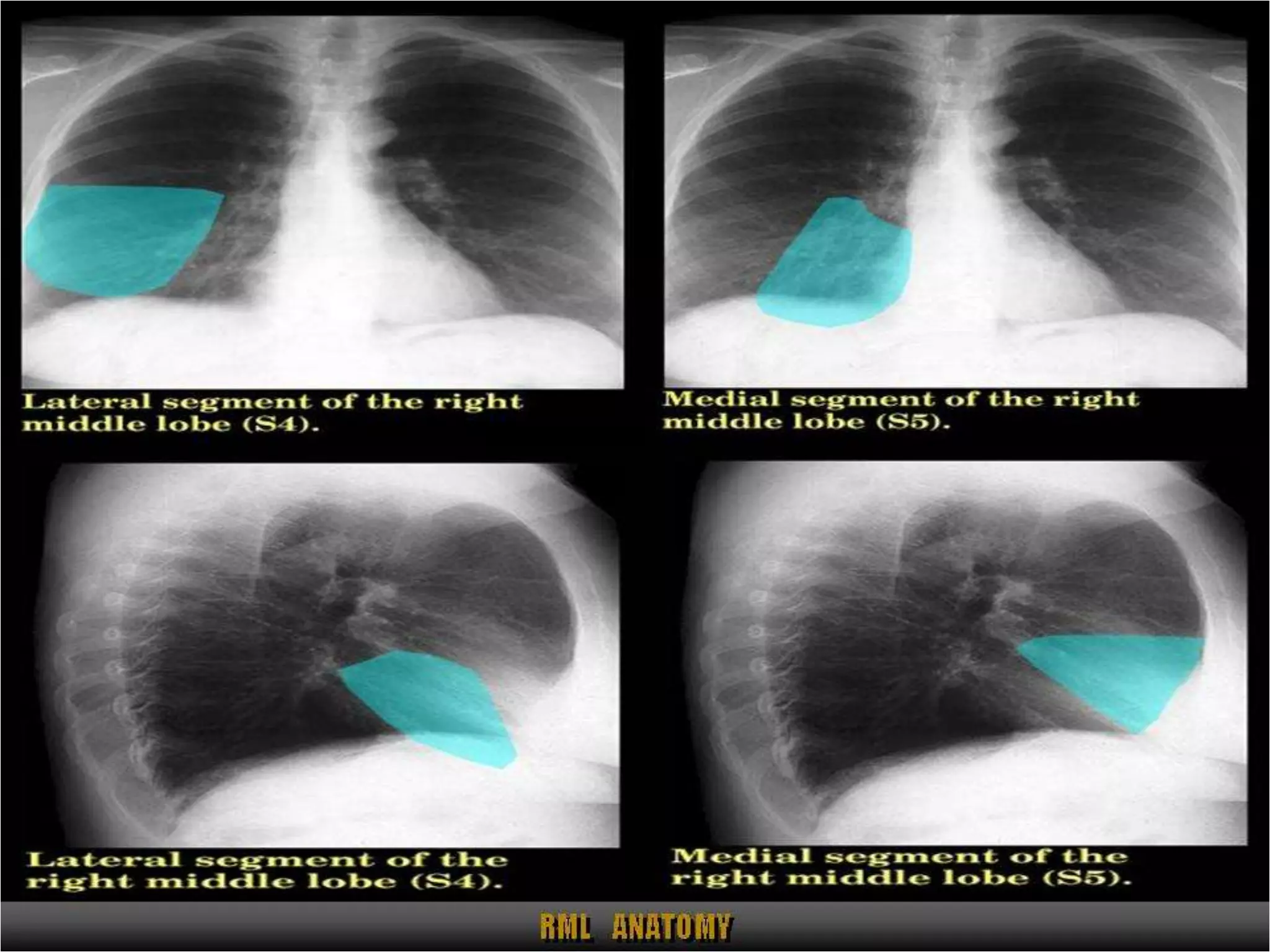 Avaliação sistemática da radiografia do tórax | PPT