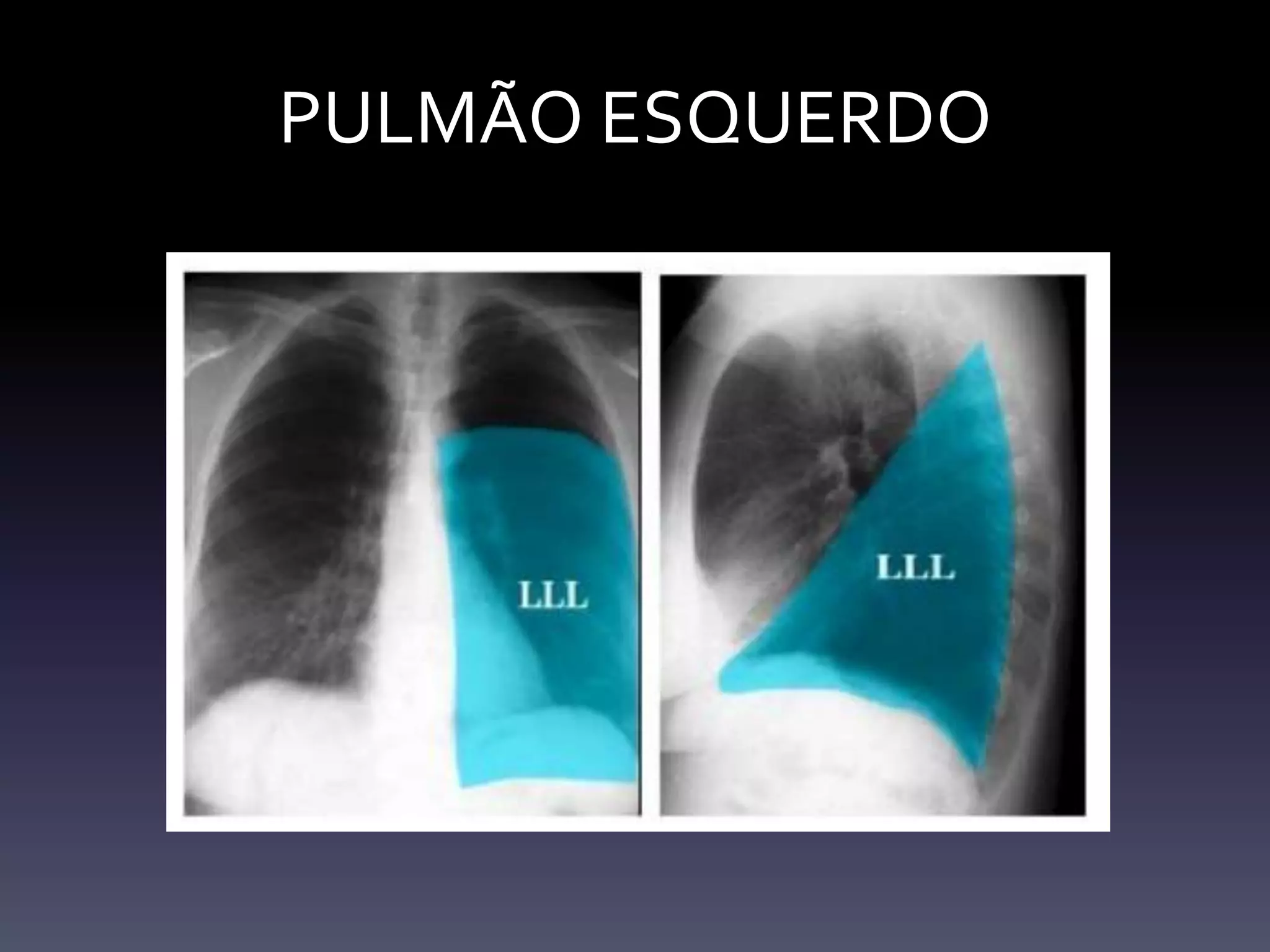 Avaliação sistemática da radiografia do tórax | PPT