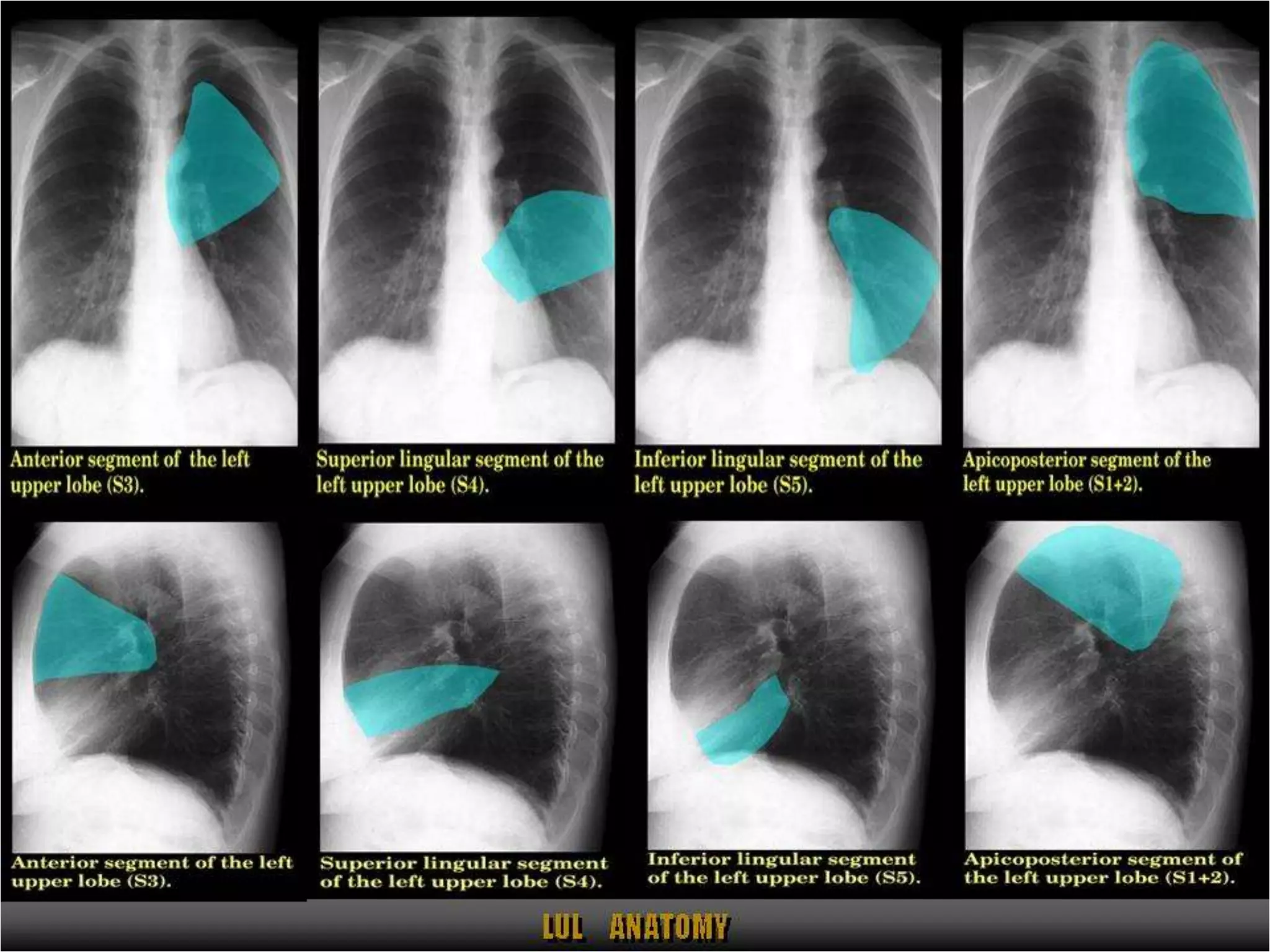 Avaliação sistemática da radiografia do tórax | PPT