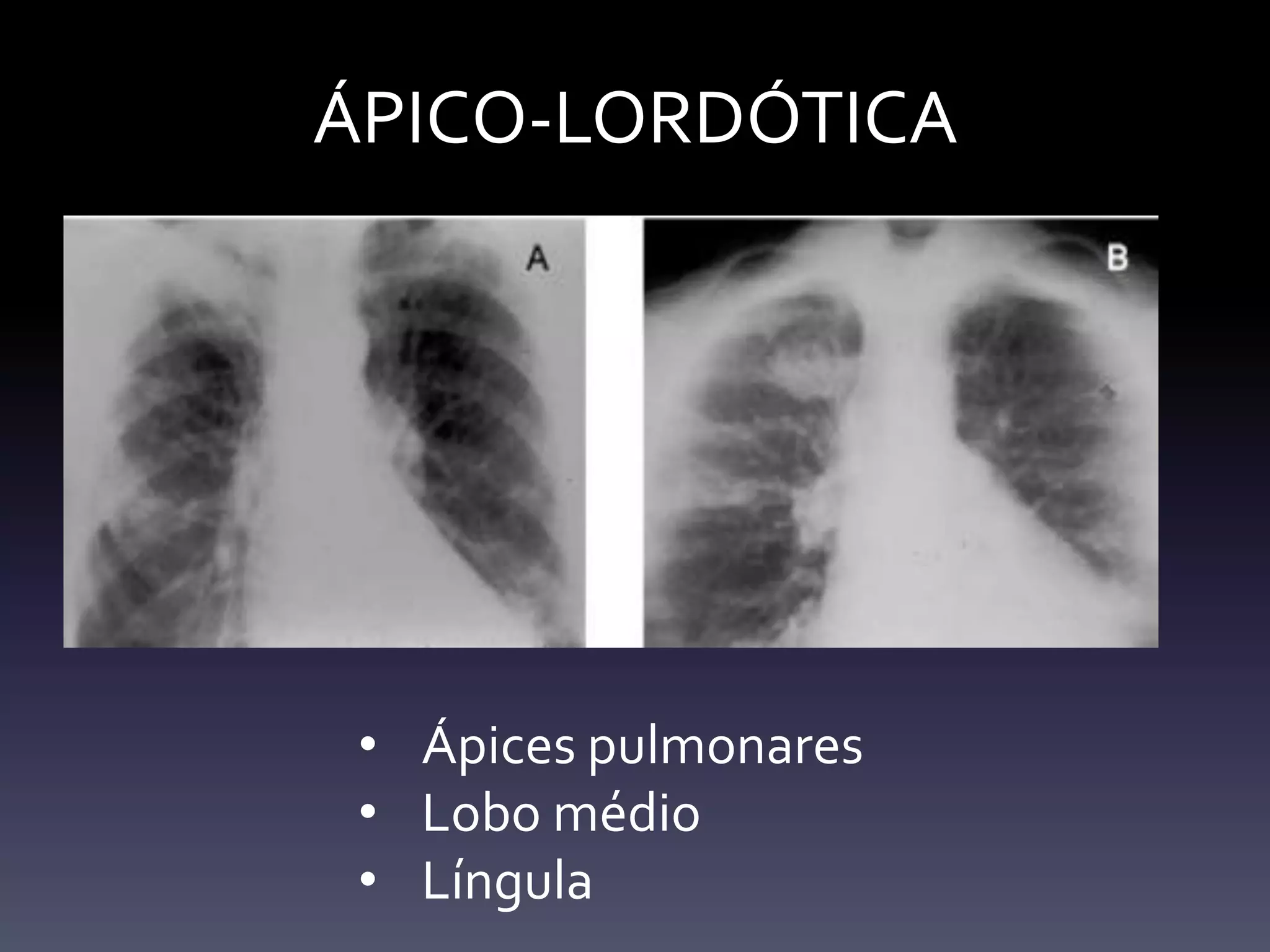 Avaliação sistemática da radiografia do tórax | PPT