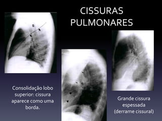 Avaliação sistemática da radiografia do tórax | PPT