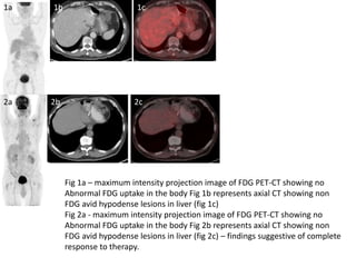 avapritinib ppt gist (gastrointestinal stromal tumor ppt).pptx