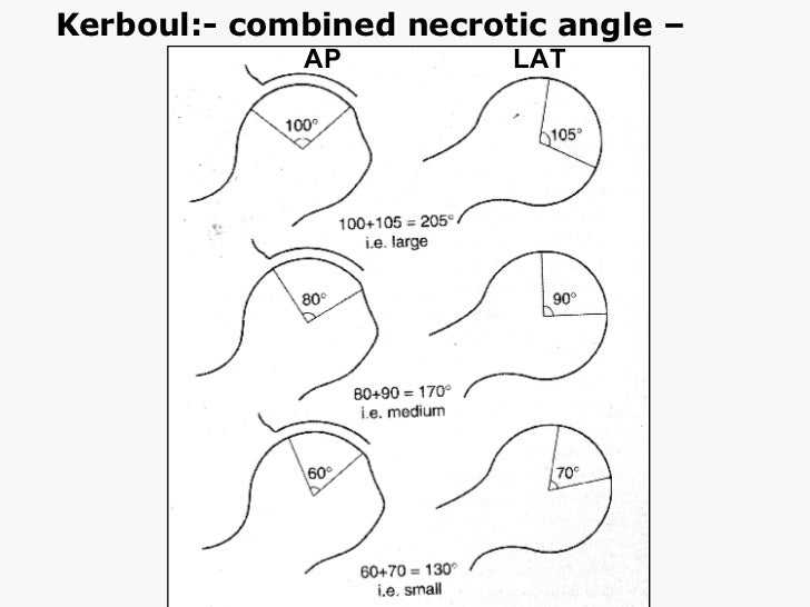 Avascular Necrosis Hip