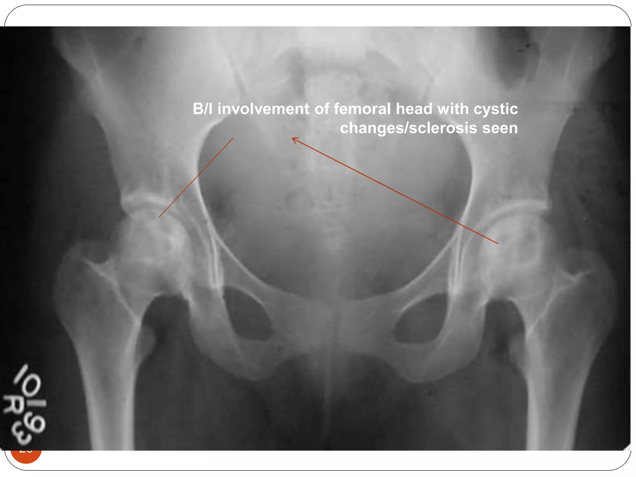Avascular necrosis Radiology | PPTX