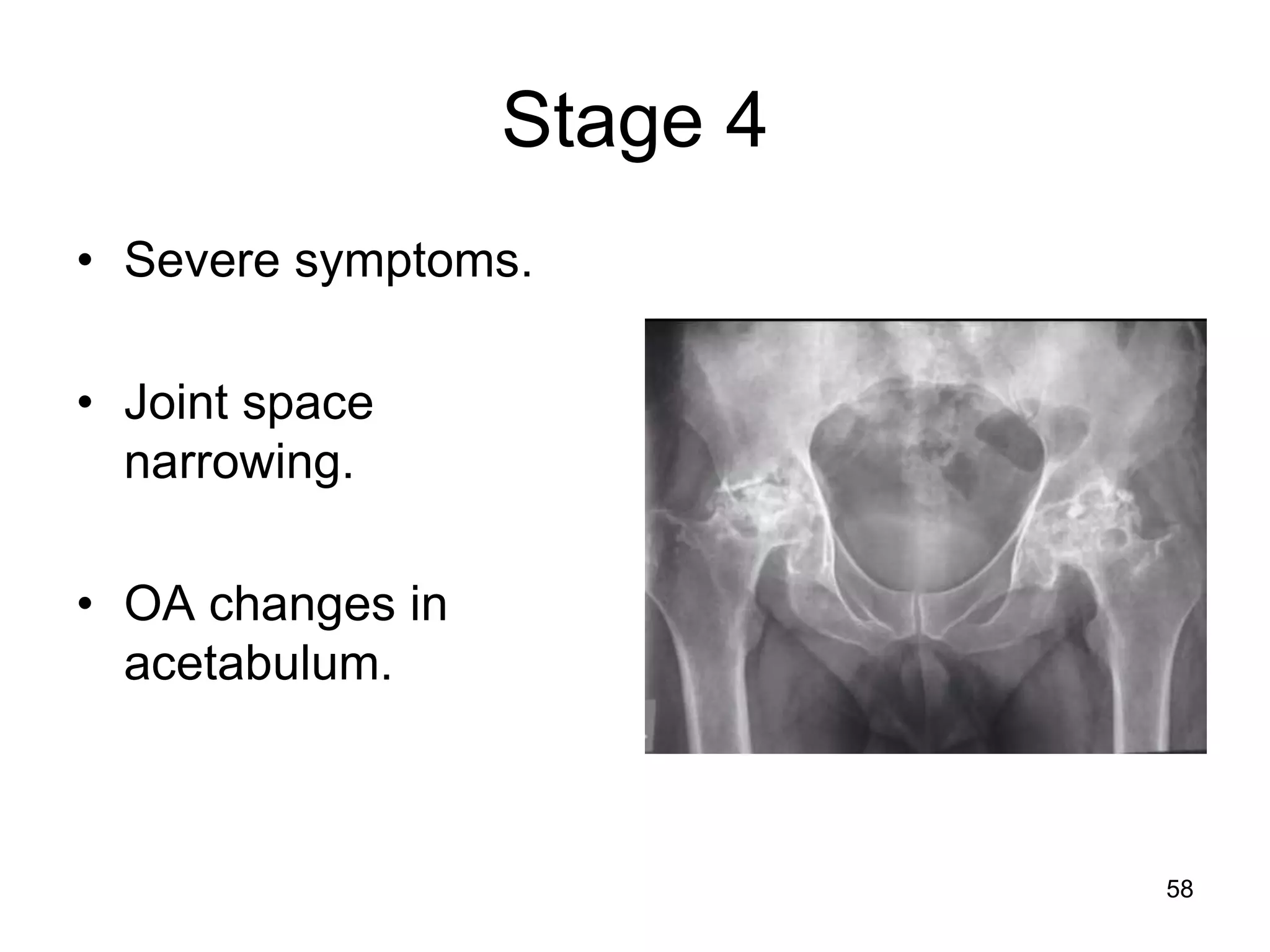 Avascular necrosis Radiology | PPTX