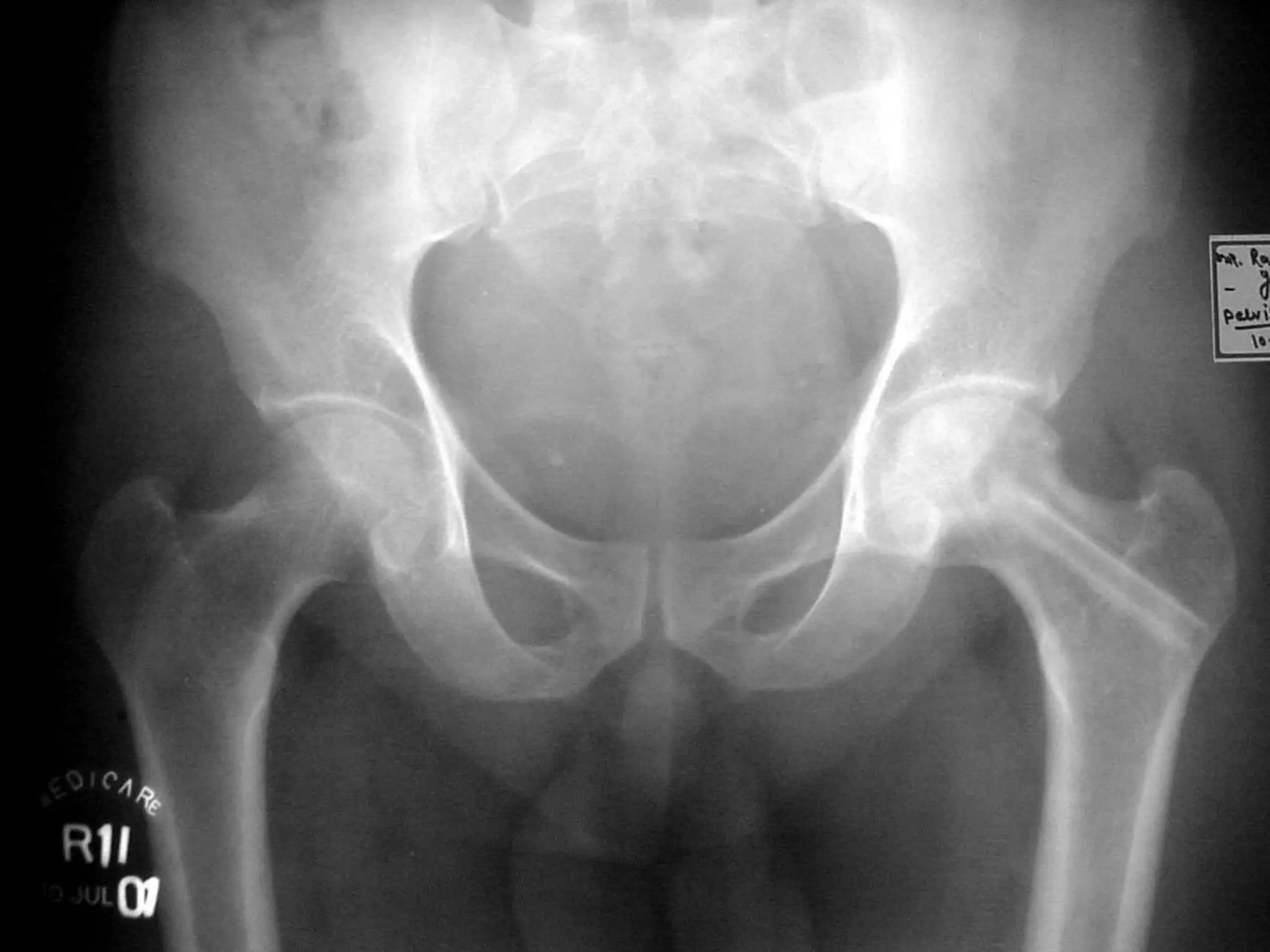 Avascular necrosis Radiology | PPTX