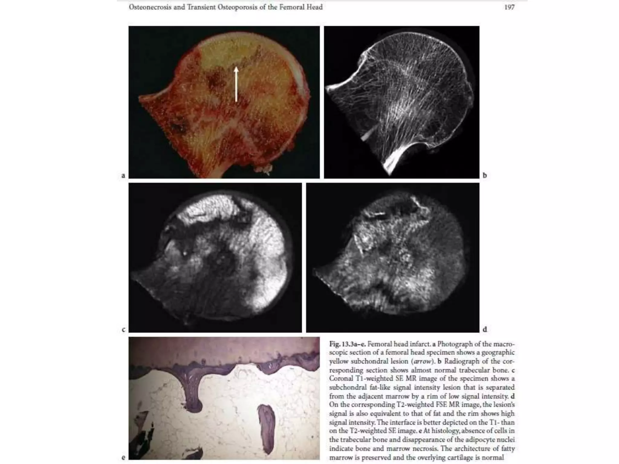 Avascular necrosis Radiology | PPTX
