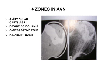 Avascular necrosis Radiology | PPTX