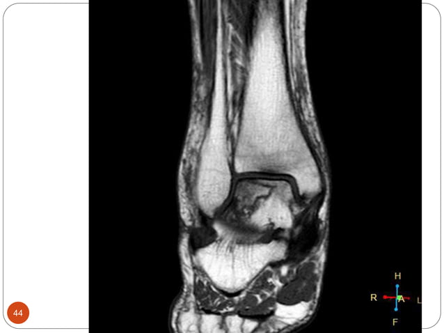 Avascular necrosis Radiology | PPTX | Blood Disorders | Diseases and ...