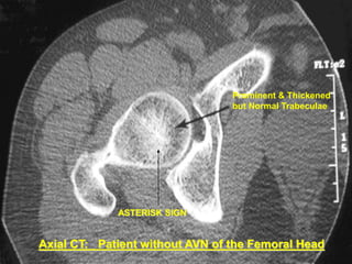 Avascular necrosis Radiology | PPTX