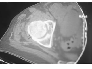 Avascular necrosis Radiology | PPTX