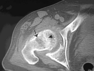 Avascular necrosis Radiology | PPTX