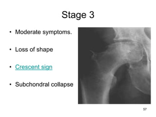 Avascular necrosis Radiology | PPTX
