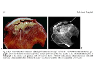 Avascular necrosis Radiology | PPTX