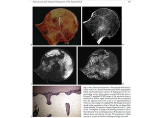 Avascular necrosis Radiology | PPTX