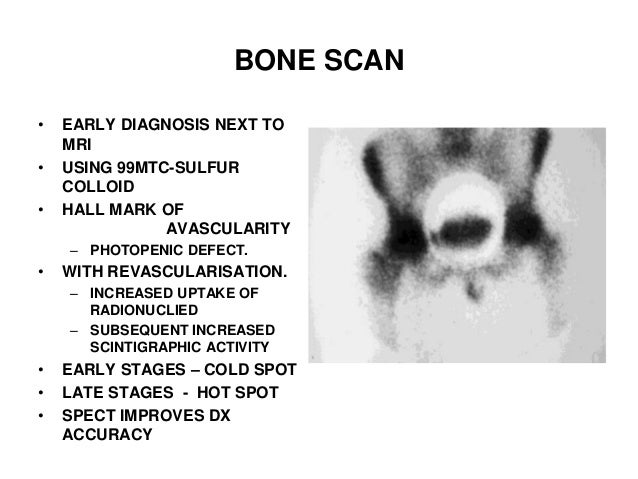 Avascular necrosis Radiology