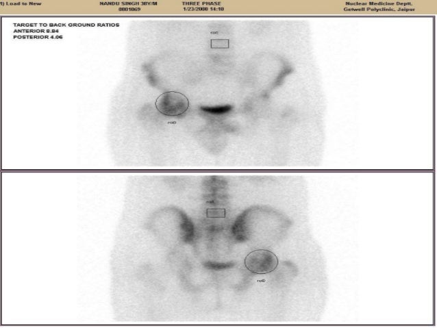 Avascular necrosis Radiology