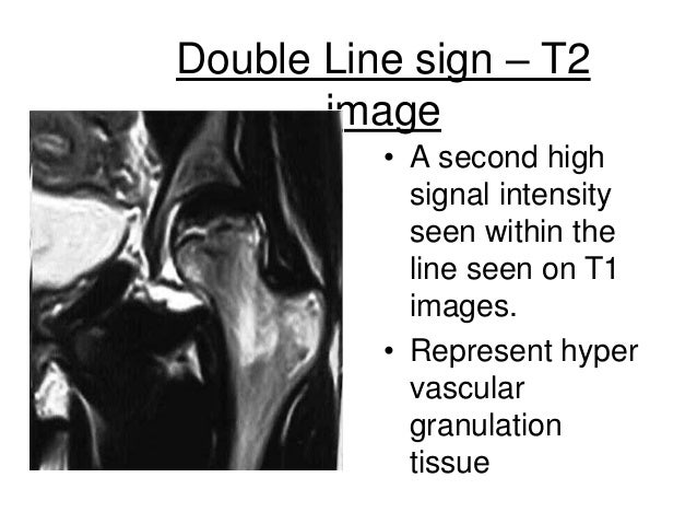 Avascular necrosis Radiology